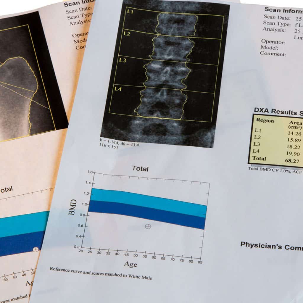Everything You Ever Wanted To Know About DXA Scans - Save Our Bones